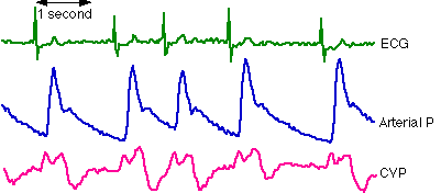Abnormal EKG’s and Corresponding Arterial Waveforms